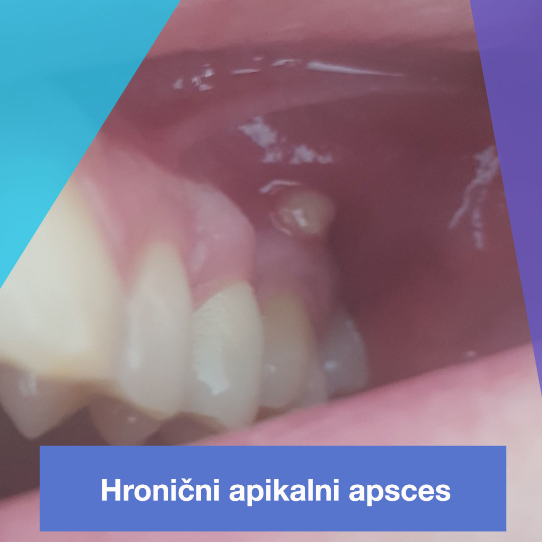 Zubić Iva Blog | Edukativni blog o dentalnoj medicini.